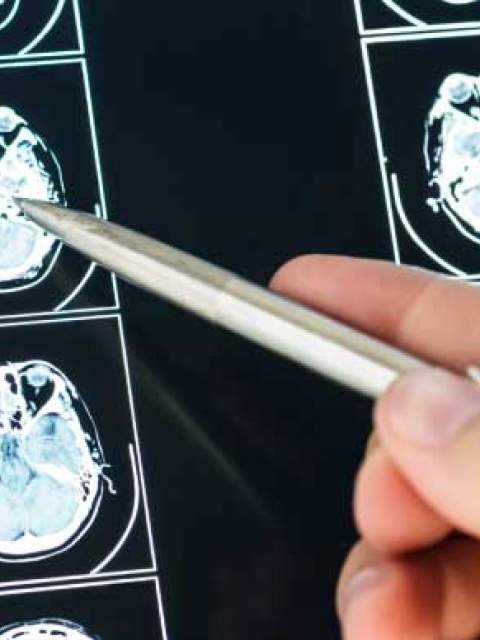 ¿Qué? ¿Cómo? Y ¿Cuándo? Del ACV (Accidente Cerebrovascular) | medPoint