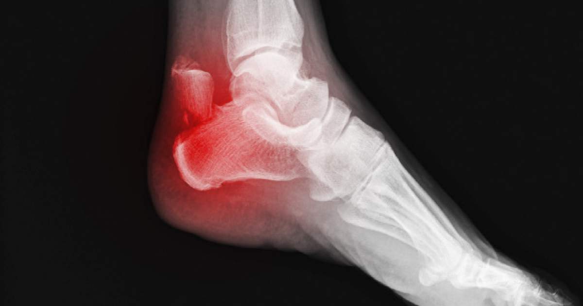 Causas del dolor en talones | medPoint