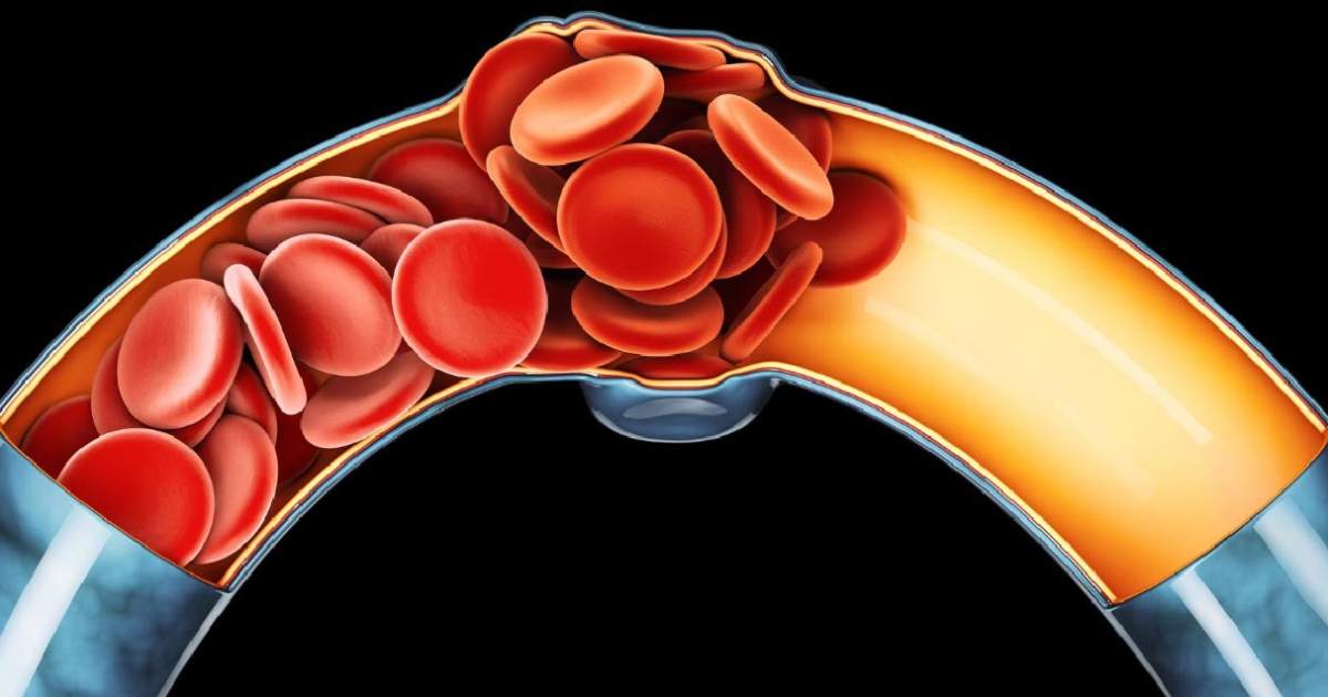 El papel del colesterol malo (LDL) en la aterosclerosis y enfermedad ...