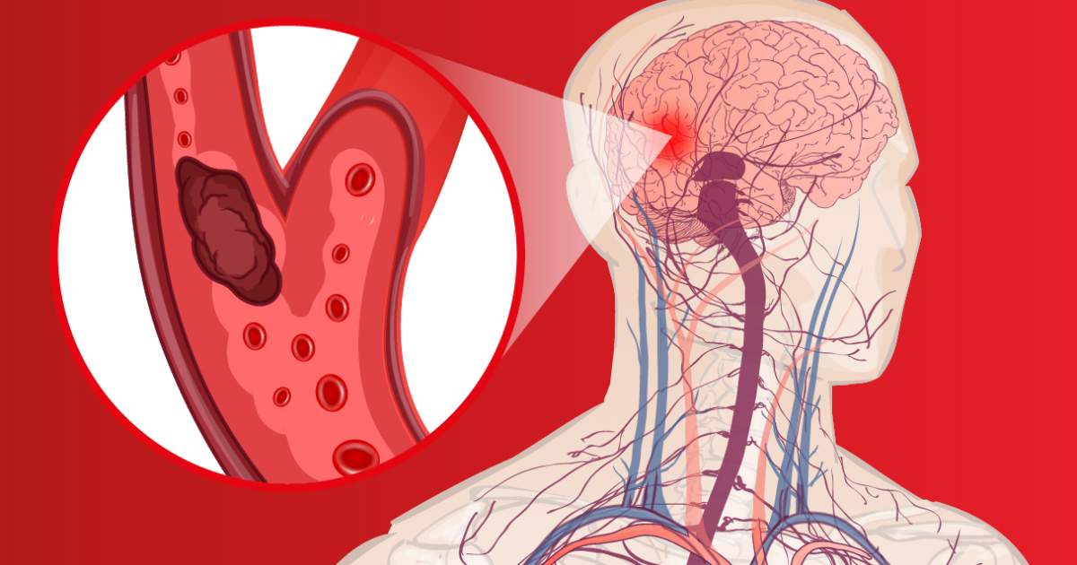 Enfermedad Vascular Cerebral Evc Medpoint