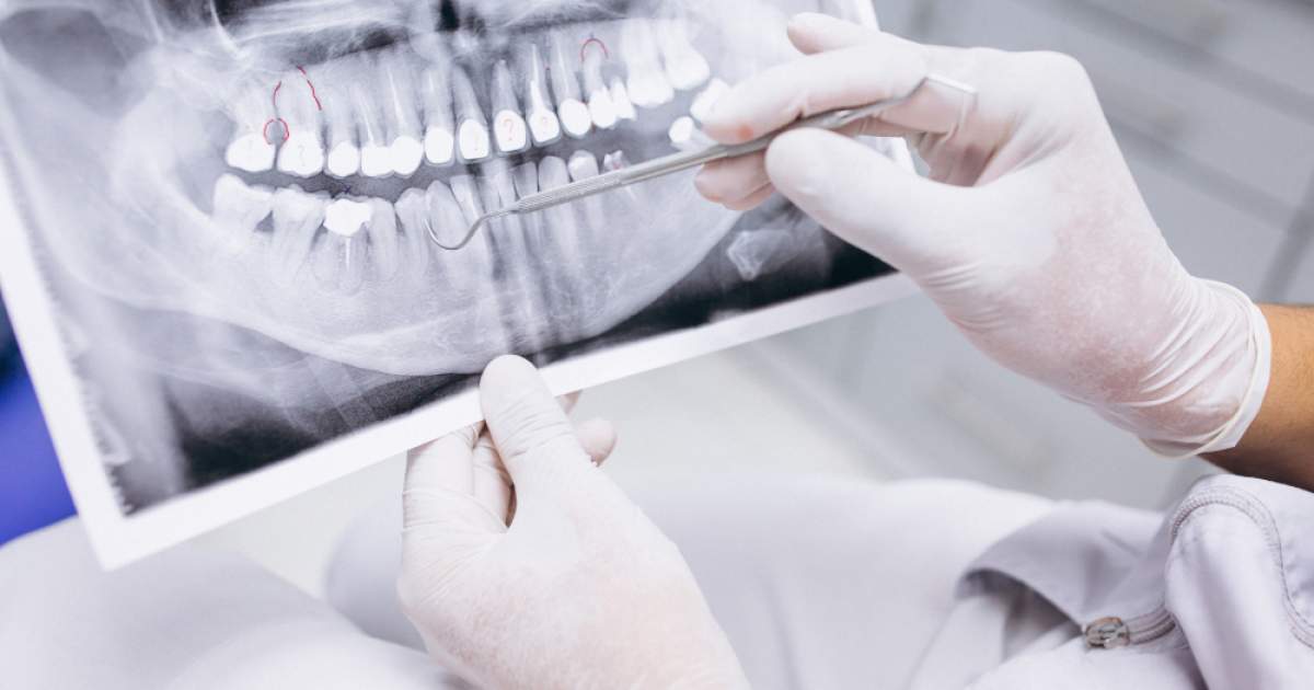 Prevenir la caída de dientes | medPoint