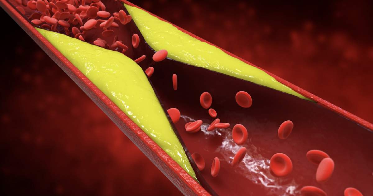 ¿Qué es la Hiperlipemia Familiar Combinada (HFC)? | medPoint